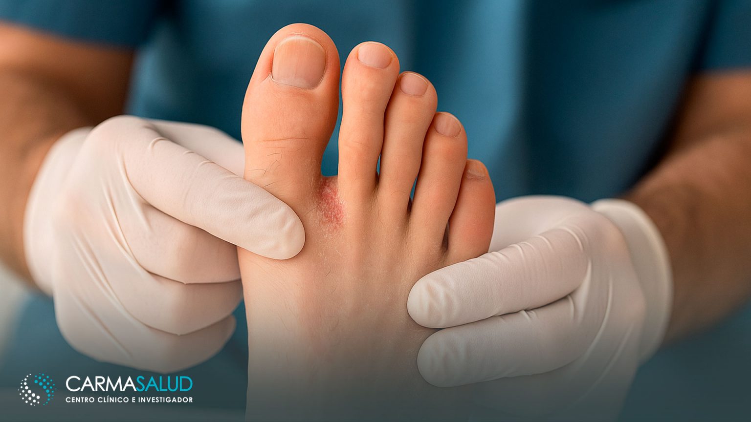 Pie de atleta (hongos en los pies): síntomas, tratamiento y prevención ...